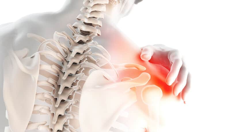 Esercizi per scapole alate: 3 spunti utili | Project inVictus