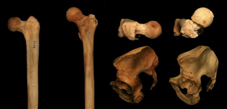 Il grande trocantere: anatomia e funzione - Project inVictus