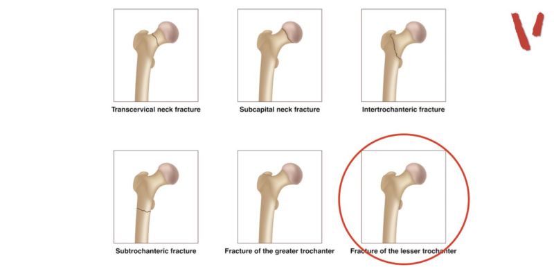 Il piccolo trocantere - Project inVictus