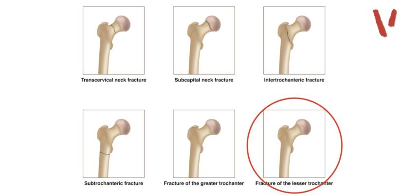 Il piccolo trocantere - Project inVictus