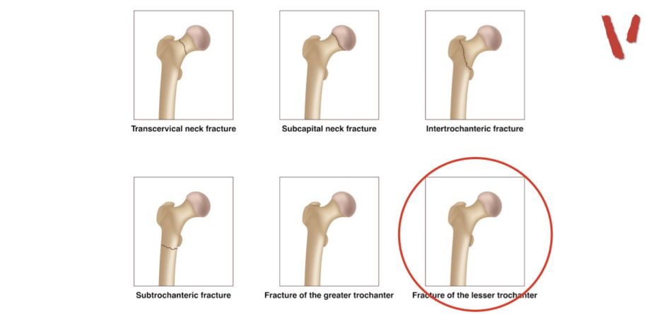 Il piccolo trocantere - Project inVictus