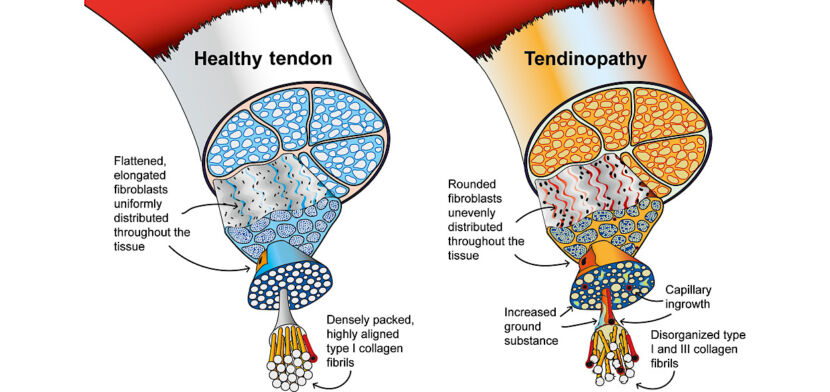 Epitrocleite: cause, cure ed esercizi efficaci - Project inVictus